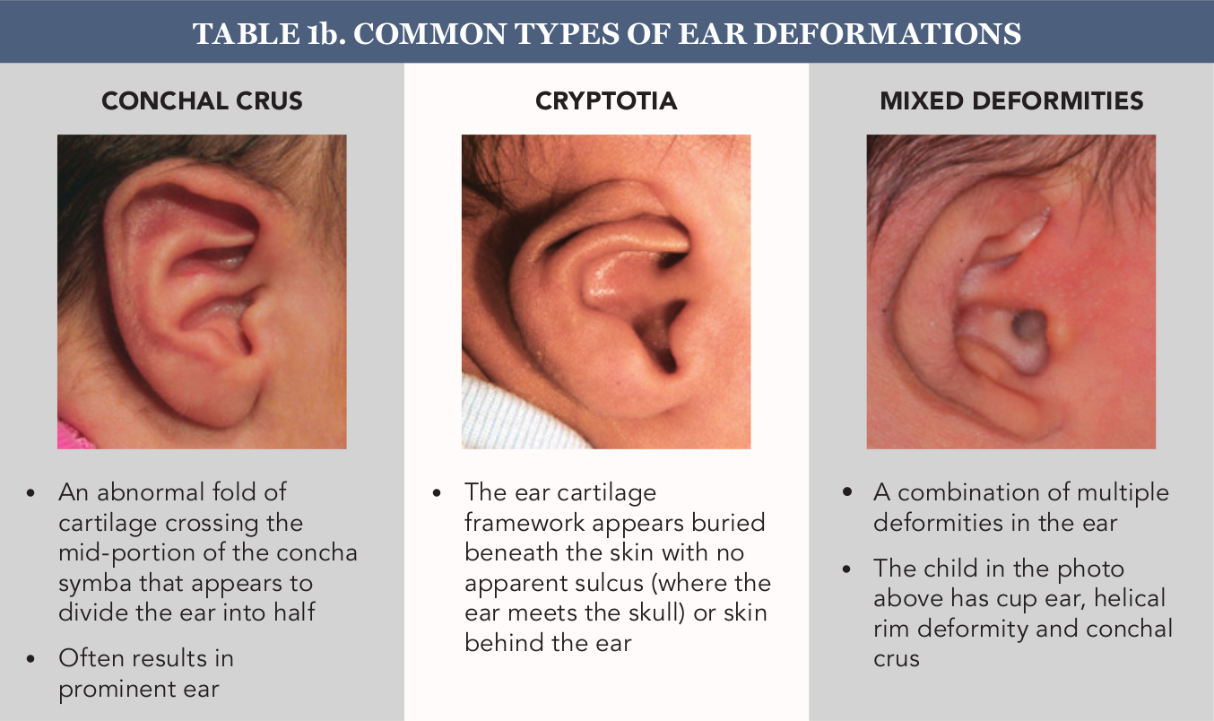 Identifying Ear Abnormality From 2d Photographs Using 56 Off